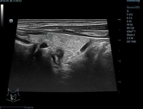 The Right Thyroid Nodule With The Maximum Diameter Of 6 Mm In A
