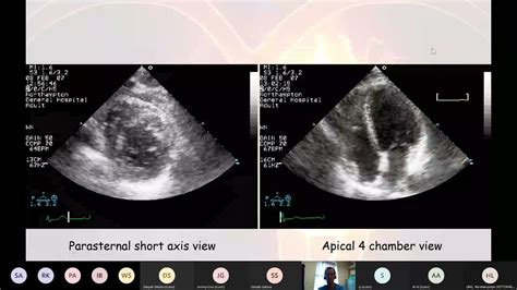 Echocardiogram Results