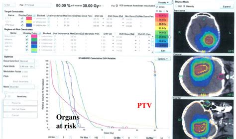 A Dose Map And Dose Volume Histogram Of A Representative Case Download Scientific Diagram
