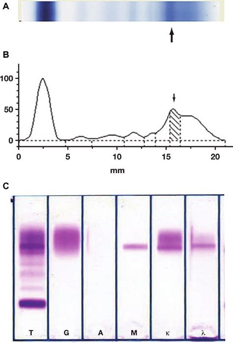 Double Gammopathic Manifestations With Immunoglobulin Igm