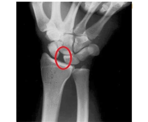 Scapholunate Dissociation —