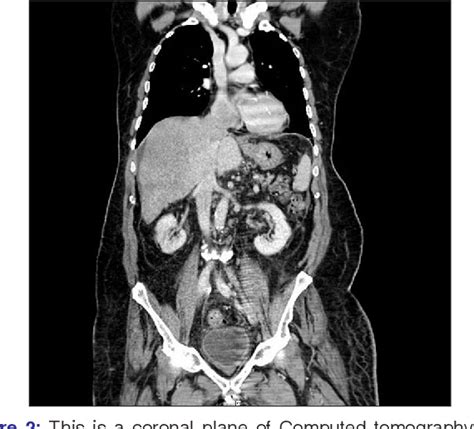 Figure 2 From Rare Case Of Hepatocellular Carcinoma Invading The Right