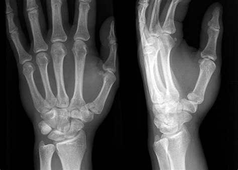 First Base Of Metacarpal