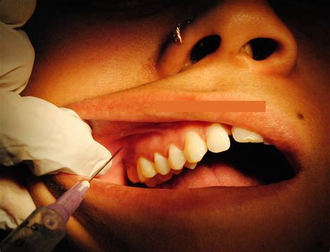 Local Anesthesia Local Anesthesia Drugs Local Anesthesia In Dentistry