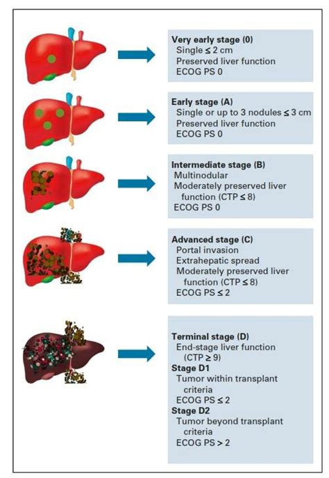 Inasl Modified Bclc Staging Of Hcc Bclc Barcelona Clinic Liver Inasl Modified Bclc Staging Of Hcc Bclc Barcelona Clinic Liver
