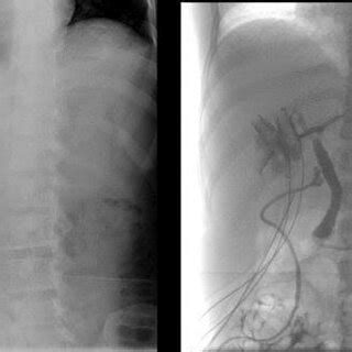 Second Cholangiogram Showing Permeable Biliary Ducts Download Scientific Diagram