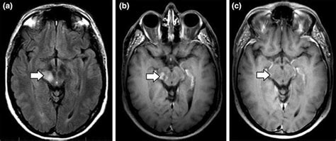 Mri Of Case 1 Showing A New Right Mesencephalic Lesion On Flair