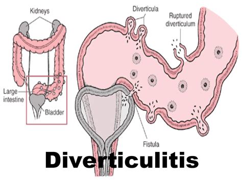 Diverticulitis And Its Nursing Management Ppt
