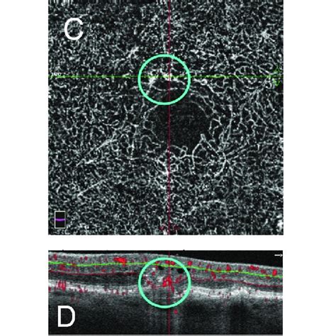 Multimodal Imaging Of Retinal Angiomatous Proliferation Rap A Download Scientific Diagram