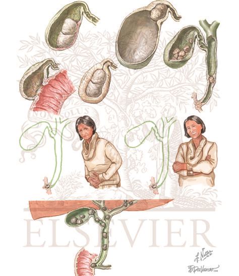 Cholelithiasis Clinical Aspects