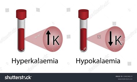 Hypokalemia People