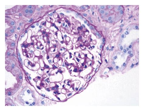 A Second Biopsy A Glomerulus With No Evidence Of Hypercellularity