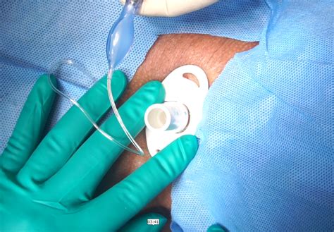 Tracheostomy How To Prepare For The Procedure Dr Ruth Otolaryngology