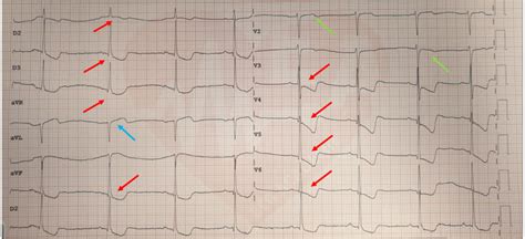 Ecg Quiz 31 Ecg Academie