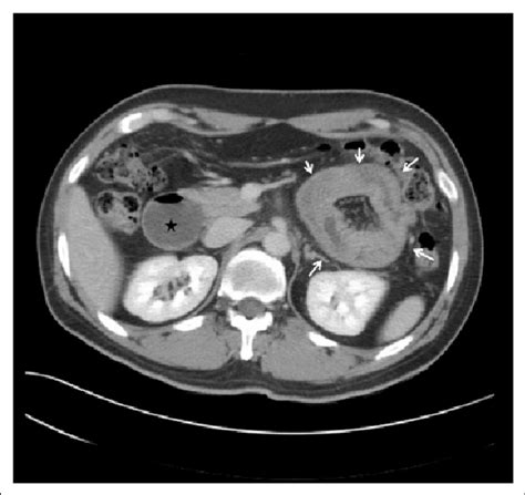 Axial Contrast Enhanced Computed Tomography Image Showing Obstructed Download Scientific