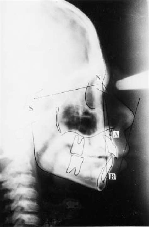 Cephalogram Of A Williams Syndrome Patient With Normal Sna And Snb Download Scientific Diagram