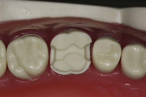 Mod Ceramic Onlay Preparation Stevenson Dental Solutions