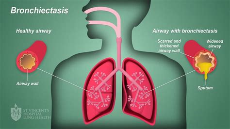 Understanding Bronchiectasis Causes Symptoms And Treatment Ask The Nurse Expert