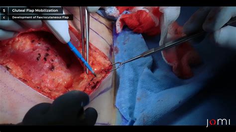 Revision Bascom Cleft Lift Pilonidal Cystectomy Jomi
