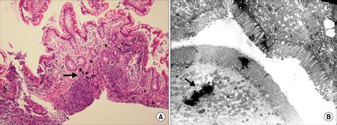 Histologic Features And Electron Microscopic Finding Of Melanosis Ilei