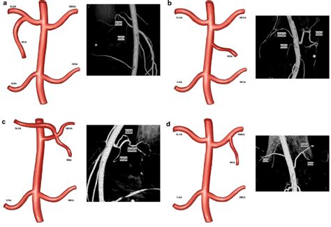The Four Types Of Genicular Artery Branching With Intraoperative Download Scientific Diagram