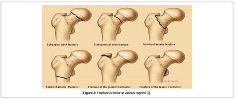 Osteoporosis And Physical Activity Fracture Femur Various Regions