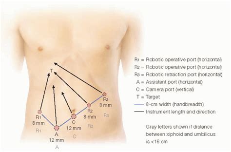 Minimally Invasive Choledochojejunostomy Basicmedical Key