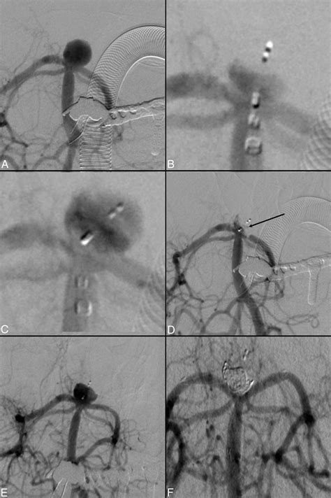 Woven Endobridge Intrasaccular Flow Disrupter For The Treatment Of Ruptured And Unruptured Wide