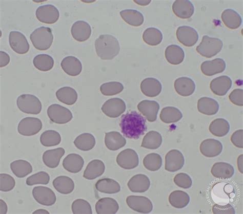 Giant Platelet