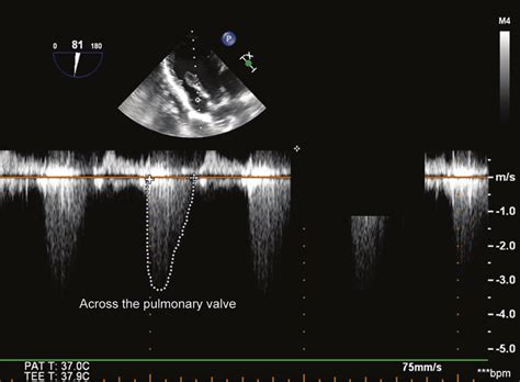 Gradient Across The Pulmonary Valve Note The Characteristic Early Download Scientific Diagram