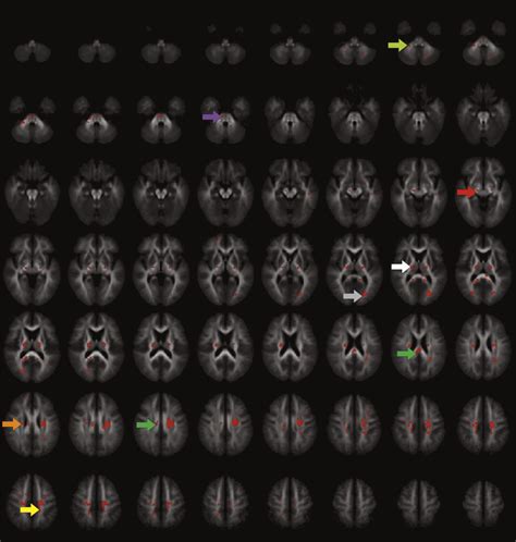 Map Of Significant Clusters Of Voxels Showing A Negative Correlation
