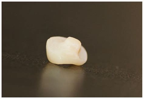 Fracture Resistance Of Resin Endocrowns With And Without Fiber