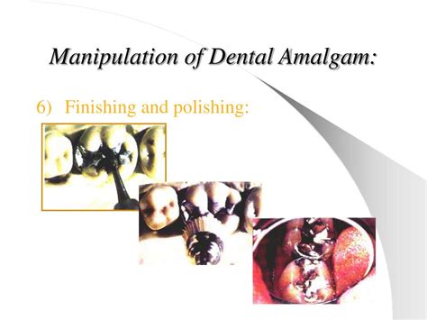 Ppt Dental Amalgam Powerpoint Presentation Free Download Id 973867