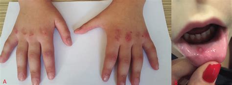 A Typical Gottrons Papules And Bilaterally Distal And Proximal