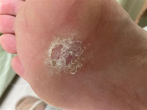 발바닥 무좀 습진 수포 병명이 궁금해요 지식in