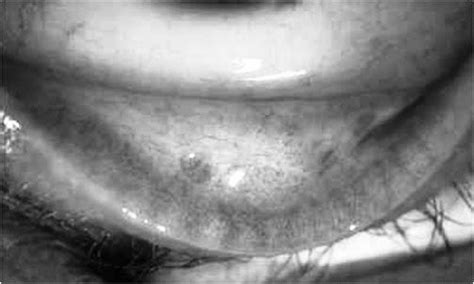 Cicatrizing Conjunctivitis Ento Key