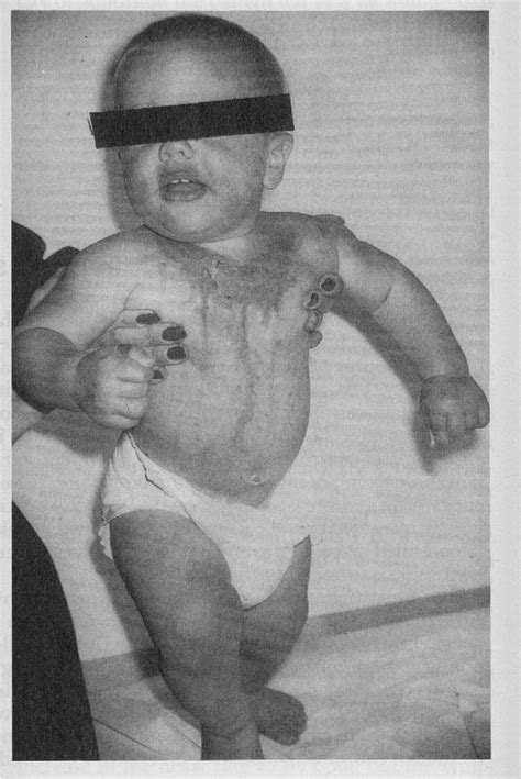 Figure 1 From Phytophotodermatitis Semantic Scholar