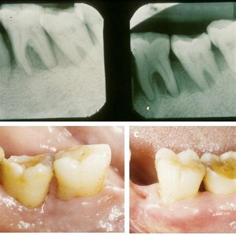 Pdf Managements Of Grade Ii Furcation Involvements Via Periodontal