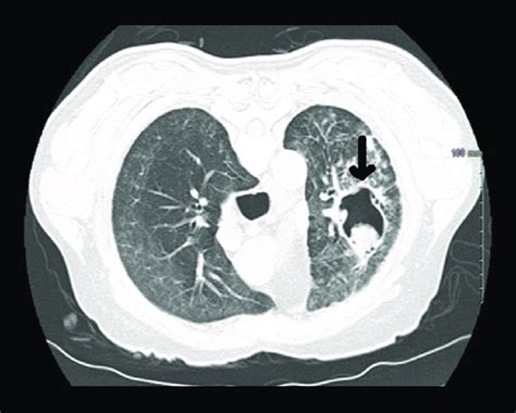 Ct Scan Of The Chest Showed The Mass Within The Cavity Moved To The Download Scientific Diagram