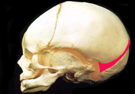 Lambdoid Synostosis Facts And Photos Craniosynostosis