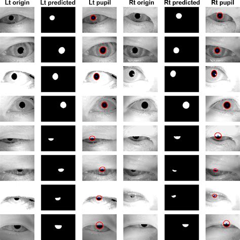 Figure 1 From Deep Learning Based Nystagmus Detection For Bppv Diagnosis Semantic Scholar