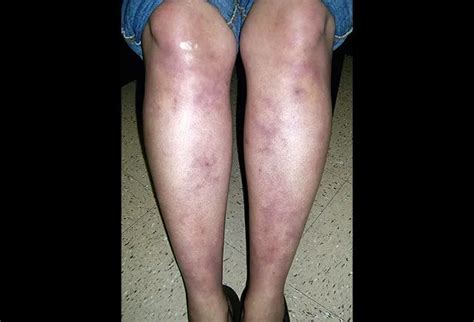 Livedo Reticularis Picture Image On