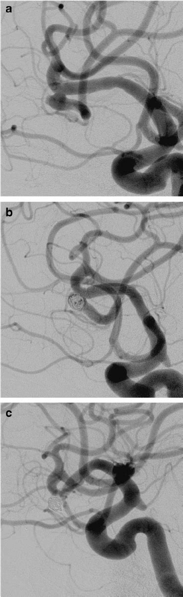 Imaging Of Incomplete Stent Expansion A Post Procedural Angiography