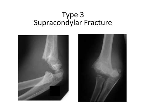 Classificaton Of Injuries Around Elbow Management Of Supracondylar Fracture Dislocation Of Elbow