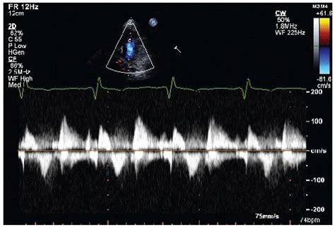 Syncopal Event With A Bruised Sternum Thoracic Key