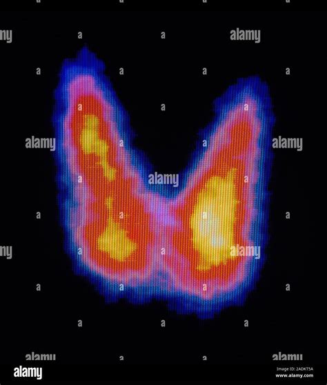 Thyroid Gland Coloured Computer Enhanced Gamma Scan Scintigram Of A