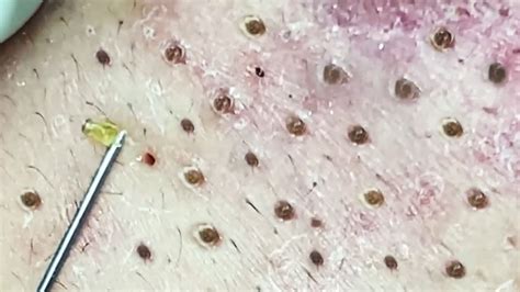 Blackhead Removal Video 93 Blackheads Blackheadsremoval