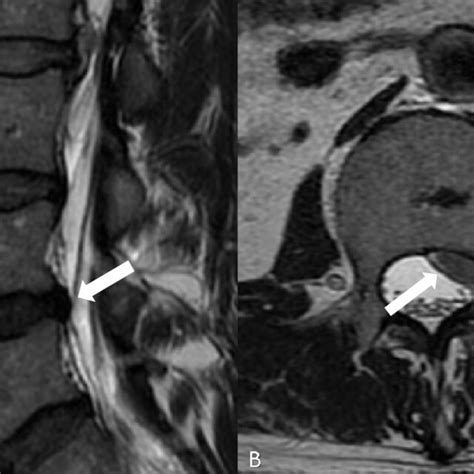 A T2 W Sagittal Plan Showing Multiple Lumbar Disc Herniations The