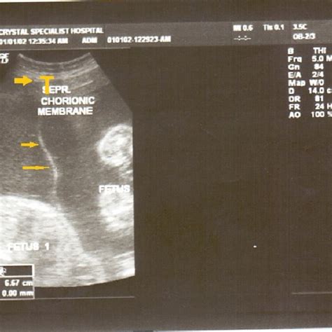 Pdf Morphological Progression Of Chorionic Membrane Development In