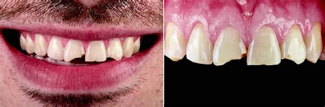 Flowable Composite Resins Esthetics At Your Fingertips Quintessence Publishing Blog